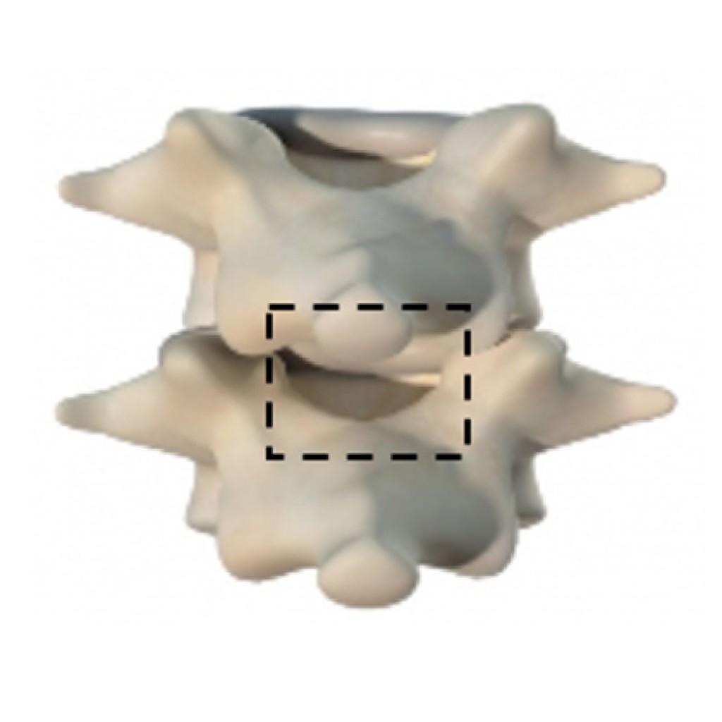 neurospine: Kanaalstenose
