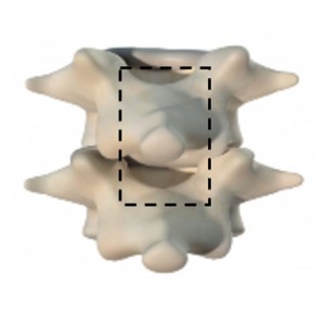 neurospine: Kanaalstenose