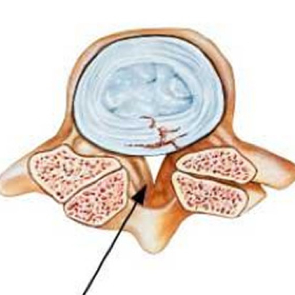 neurospine: Kanaalstenose