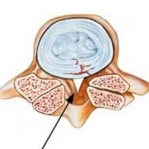 neurospine: Kanaalstenose